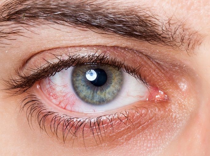 Baryta carbonica (Bar-c) I What is Isopathy? | Pink Eye No More ...