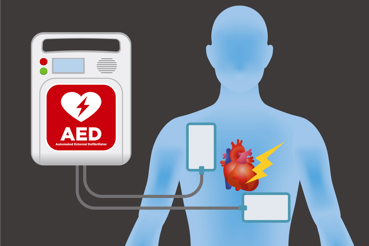 AEDs Saving Lives AEDs Saving Lives